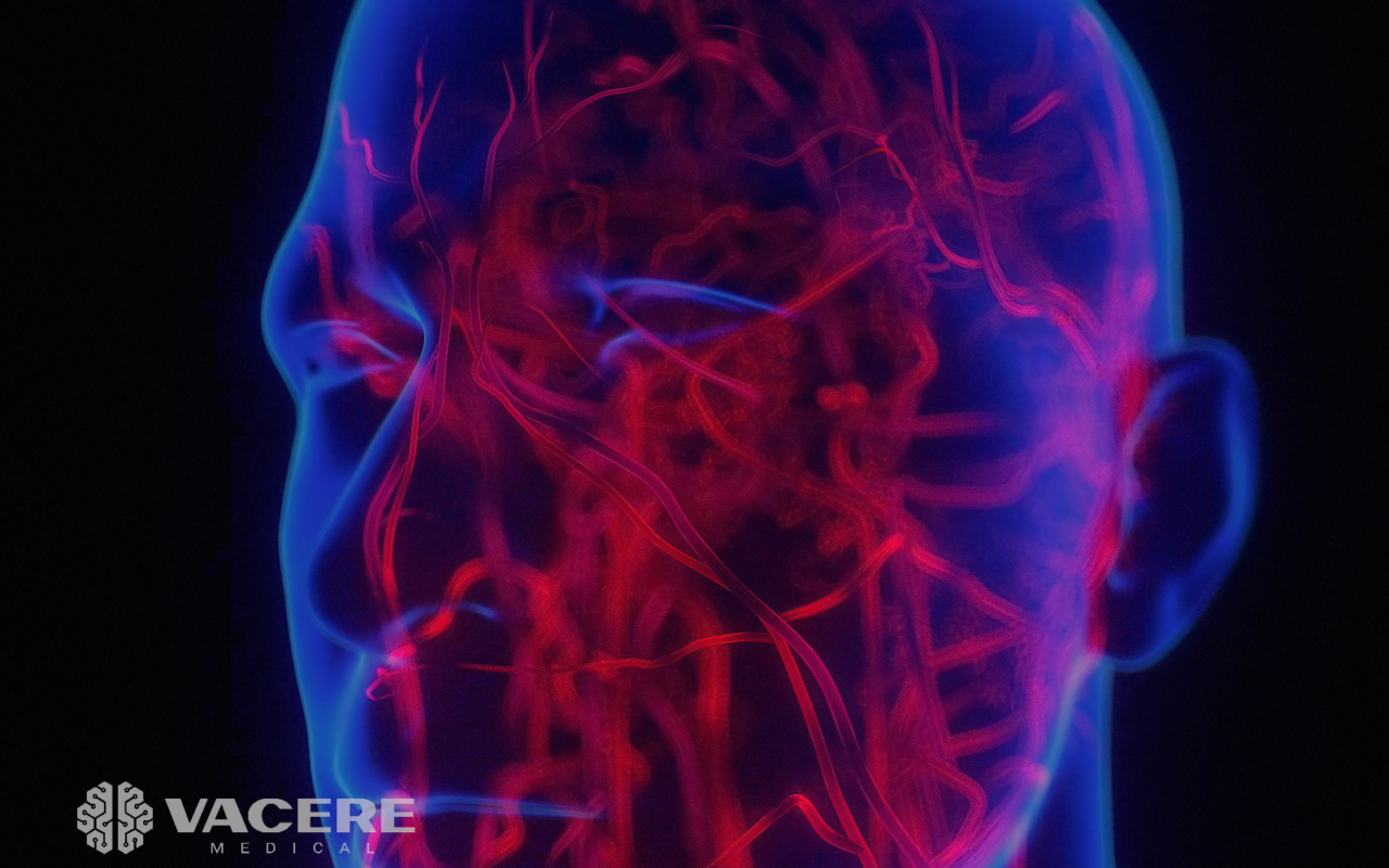VACERE Medical, Inc. | A groundbreaking emergency treatment for stroke ...